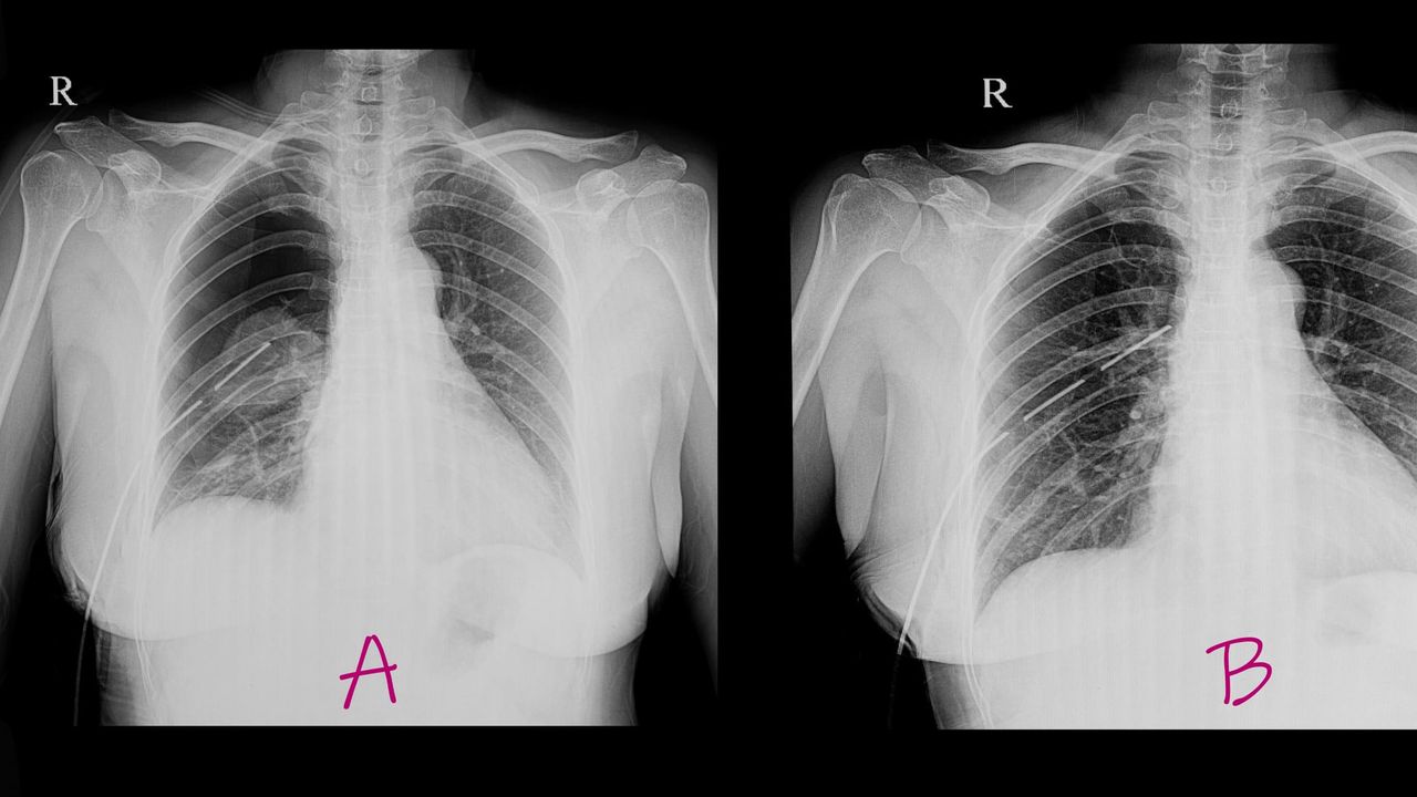 1 de cada 3,000 personas tiene un gen defectuoso que los predispone a ...